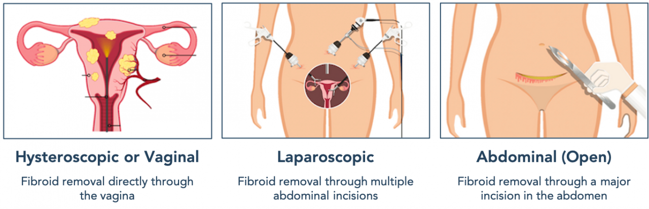 Pictures of Stomach After Myomectomy Surgery